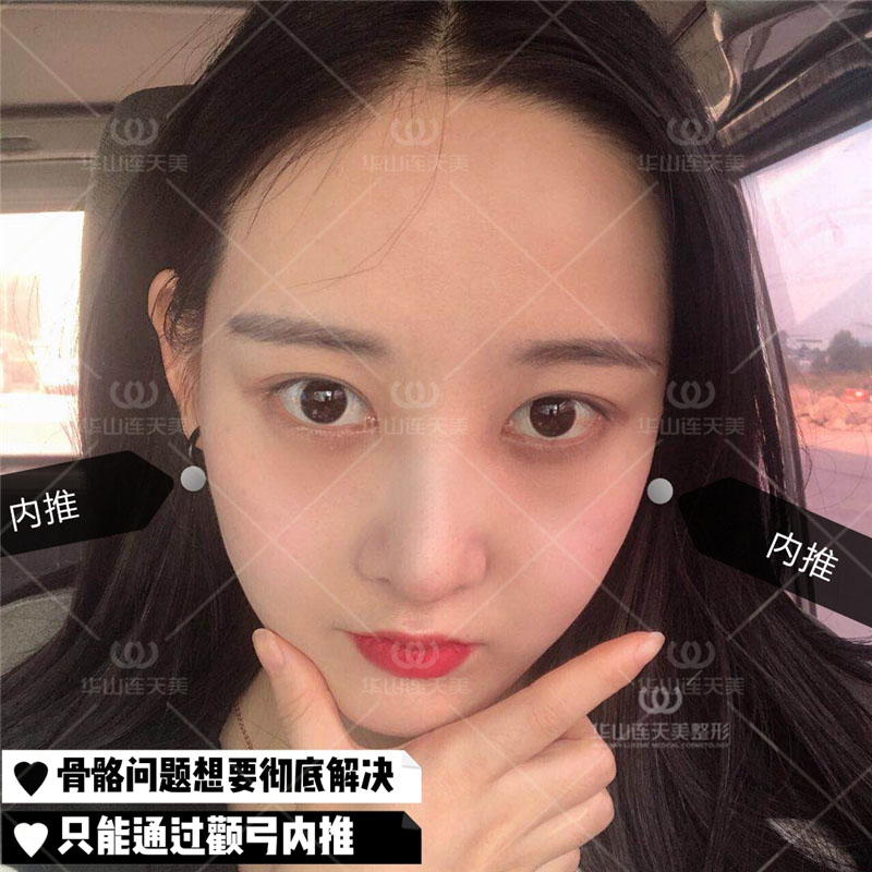 【案例解析】菱形脸!到底是太阳穴凹陷还是颧弓外扩? 高俊明主任医师 爱问医生